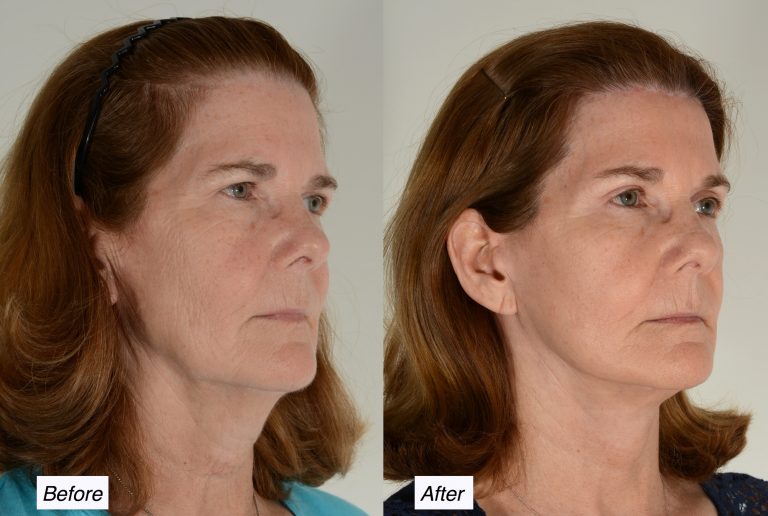 Facelift, Revision Facelift – Charleston Facial Plastic Surgery - SC