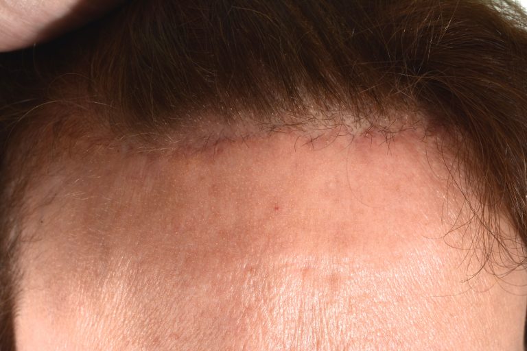 Brow Lift Charleston | Forehead Lift | Charleston Facial Plastic Surgery