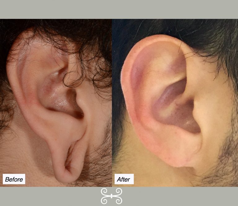 Earlobe Repair Charleston | Stretched-Out Earlobes | Dr. Rodwell
