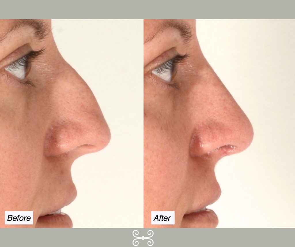 Rhinoplasty in Charleston | Dr. David Rodwell Rhinoplasty in Charleston | Dr. David Rodwell