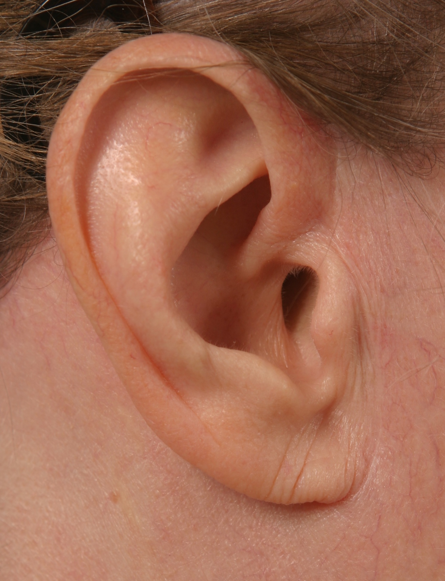 facelift ear incision - Charleston Facial Plastic Surgery