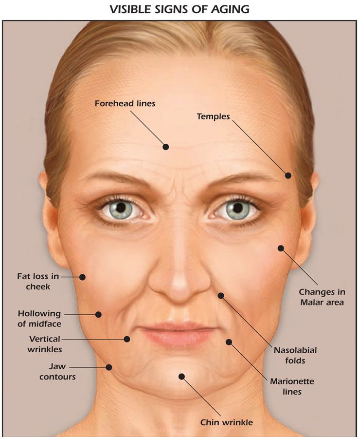 Using Fillers For Cheeks Charleston Facial Plastic Surgery Using Fillers For Cheeks Charleston Facial Plastic Surgery