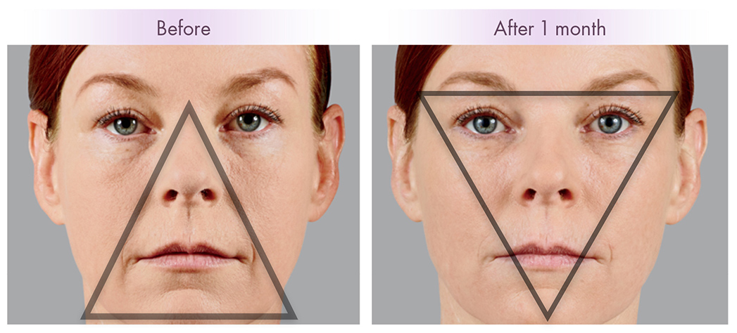 Understanding Facial Aging - Charleston Facial Plastic Surgery Understanding Facial Aging - Charleston Facial Plastic Surgery