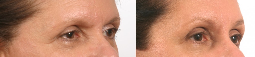 Tired of Looking Tired? - Browlift - Charleston Facial Plastic Surgery