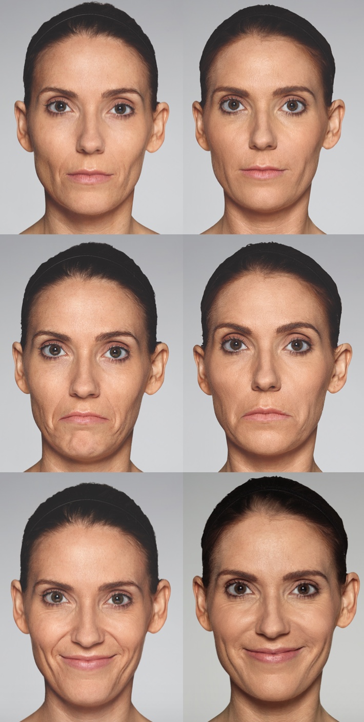 New Restylane fillers - Restylane Refyne and Restylane Defyne