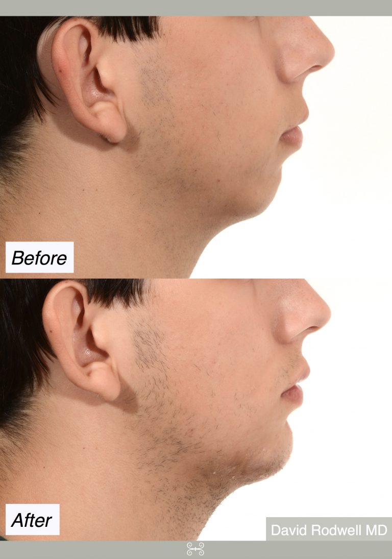 Chin Implants |Enhance Your Facial Proportion | Charleston, SC