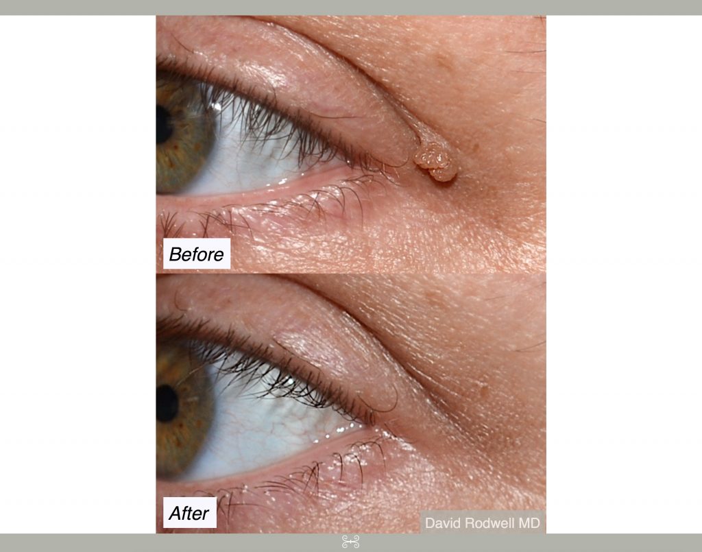 eye lesion1 - Charleston Facial Plastic Surgery