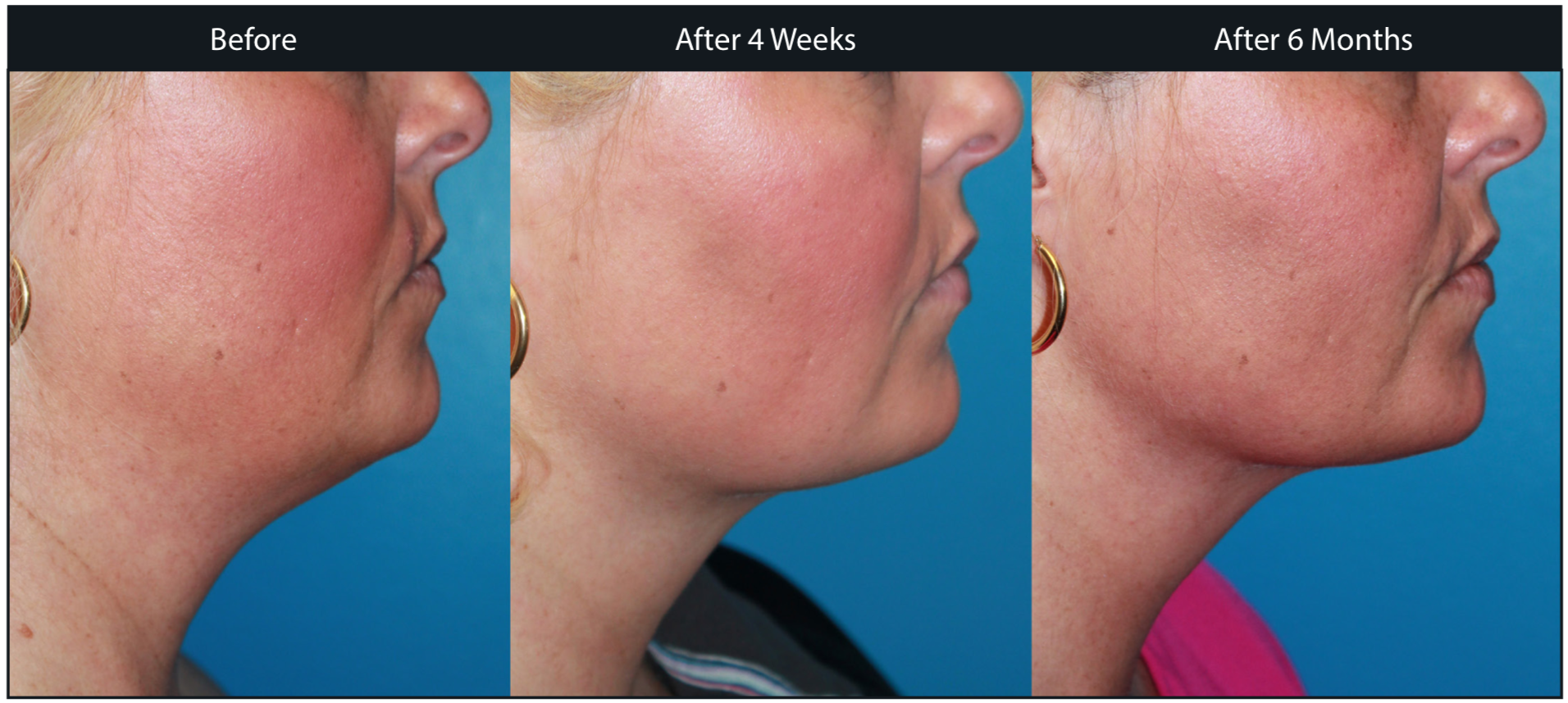 FaceTite Charleston | Non-Surgical Skin Tightening | Dr. David Rodwell