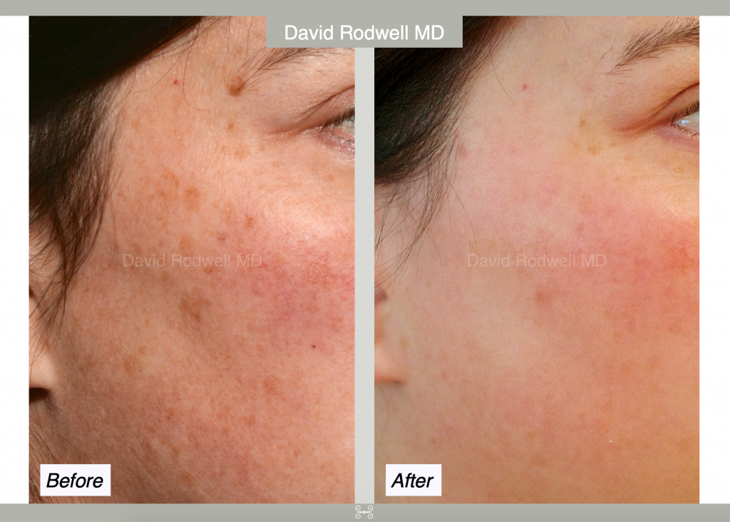 IPL 1 treatment - Charleston Facial Plastic Surgery